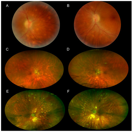Birdshot Chorioretinopathy: A Review