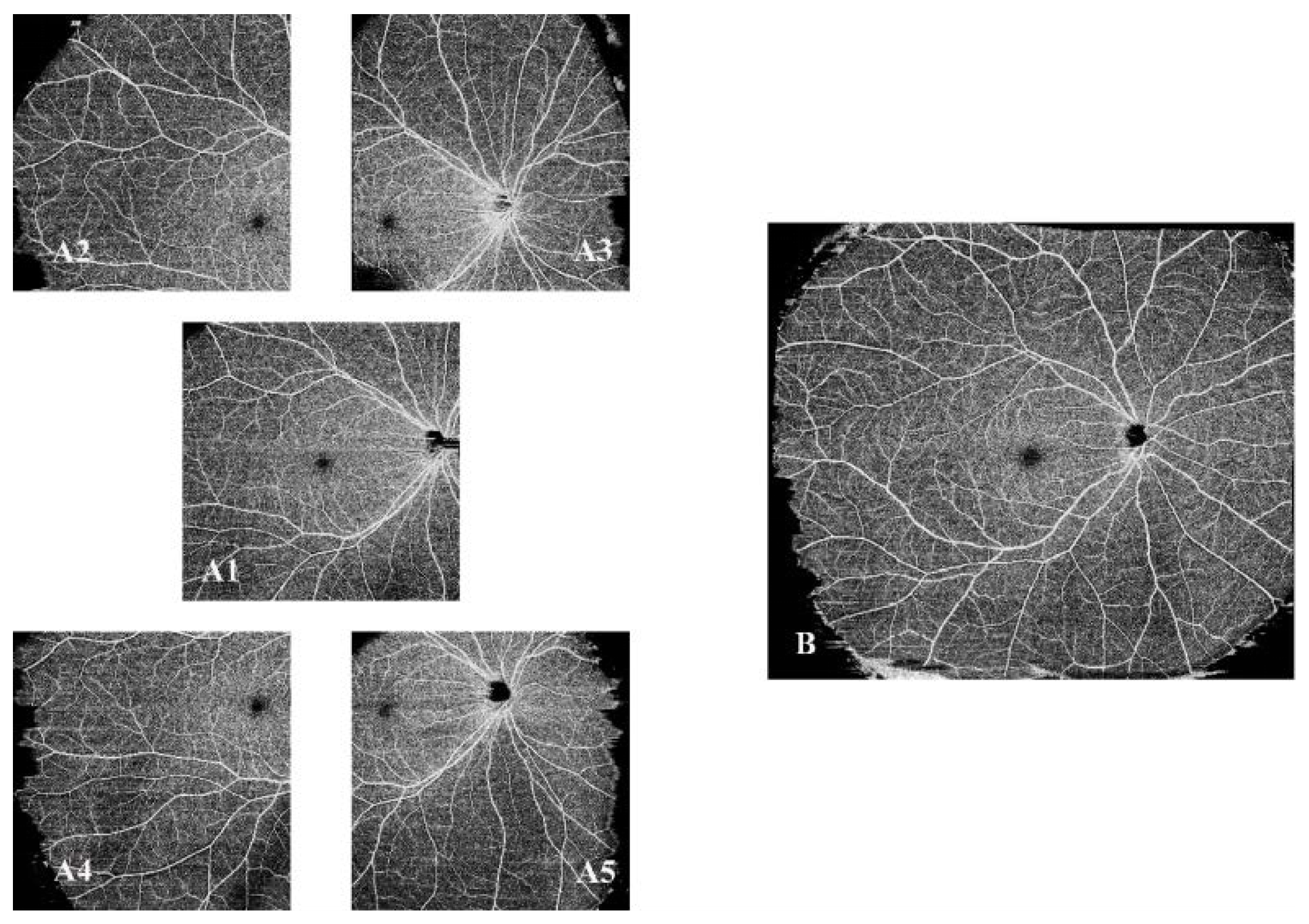 Analysis of White and Dark without Pressure in a Young Myopic Group ...