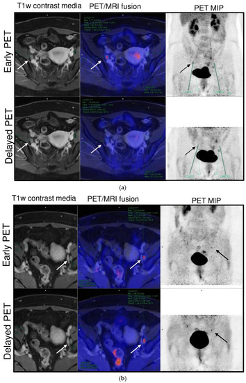 Multiparametric Dual-Time-Point [18F]FDG PET/MRI for Lymph Node Staging ...