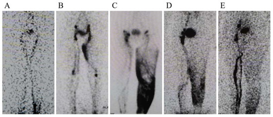 Correlation between Lymphatic Surgery Outcome and Lymphatic Image ...