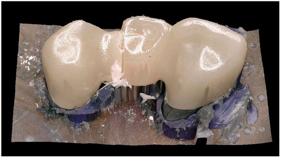 Fracture Load and Fracture Patterns of Monolithic Three-Unit Anterior ...