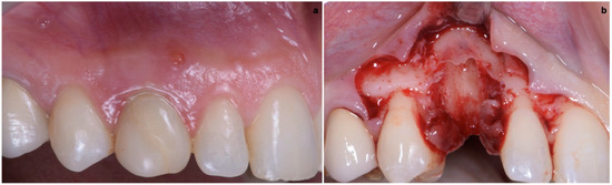 A Novel Muco-Gingival Approach for Immediate Implant Placement to ...
