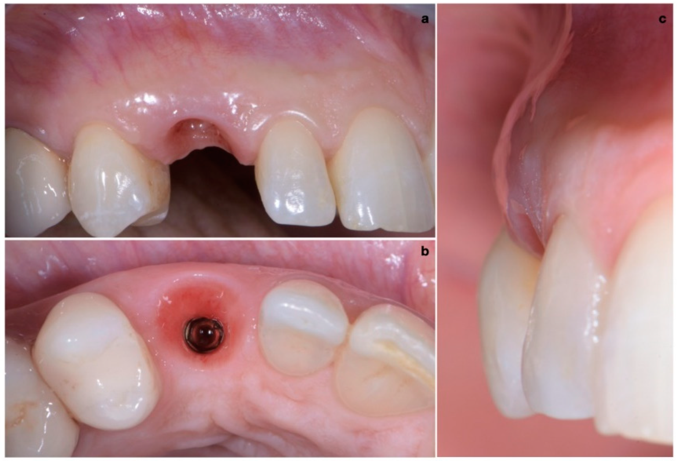 A Novel Muco-Gingival Approach for Immediate Implant Placement to ...