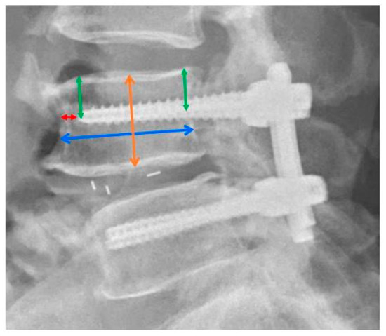 Robot-Assisted Pedicle Screw Placement Led to Lower Screw Loosening ...