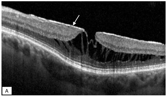 Primary Lamellar Macular Holes: To Vit or Not to Vit