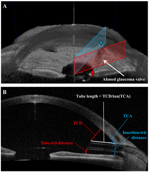Tube–Iris Distance and Corneal Endothelial Cell Damage Following Ahmed ...