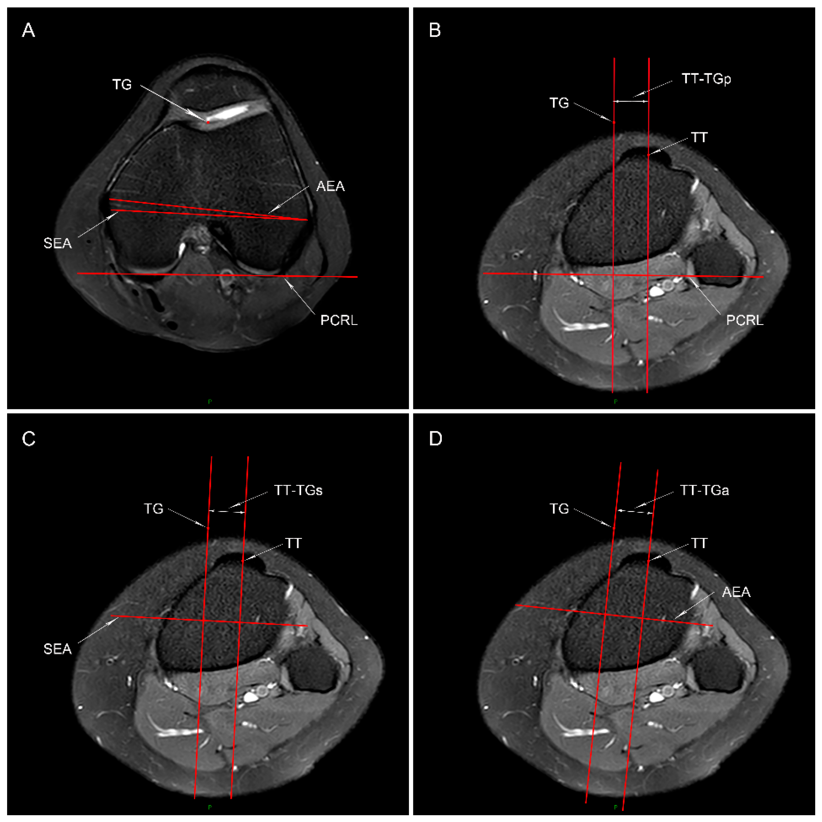 JCM | Free Full-Text | Tibial Tubercle to Trochlear Groove Distance ... JCM | Free Full-Text | Tibial Tubercle to Trochlear Groove Distance ...