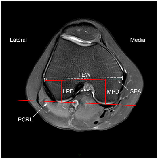 Tibial Tubercle to Trochlear Groove Distance Measured by Posterior ...