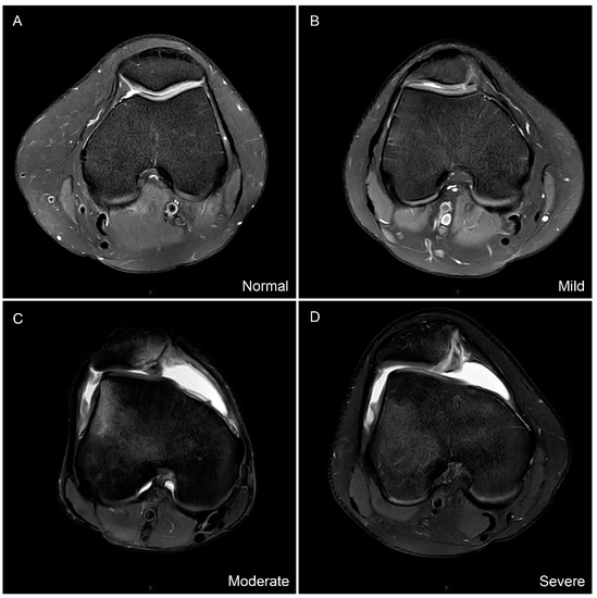 Tibial Tubercle to Trochlear Groove Distance Measured by Posterior ...