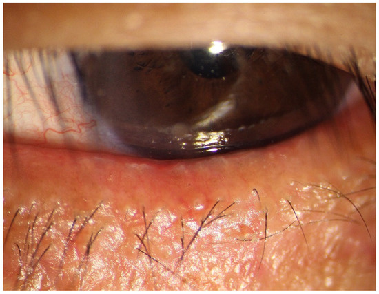 Uneven Meibomian Gland Dropout in Patients with Meibomian Gland ...
