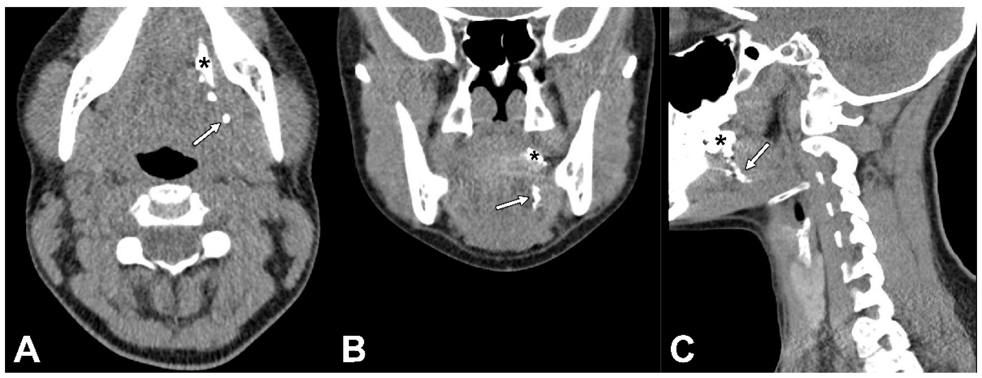 Jcm Free Full Text Ct Lymphography Using Lipiodol® For Sentinel