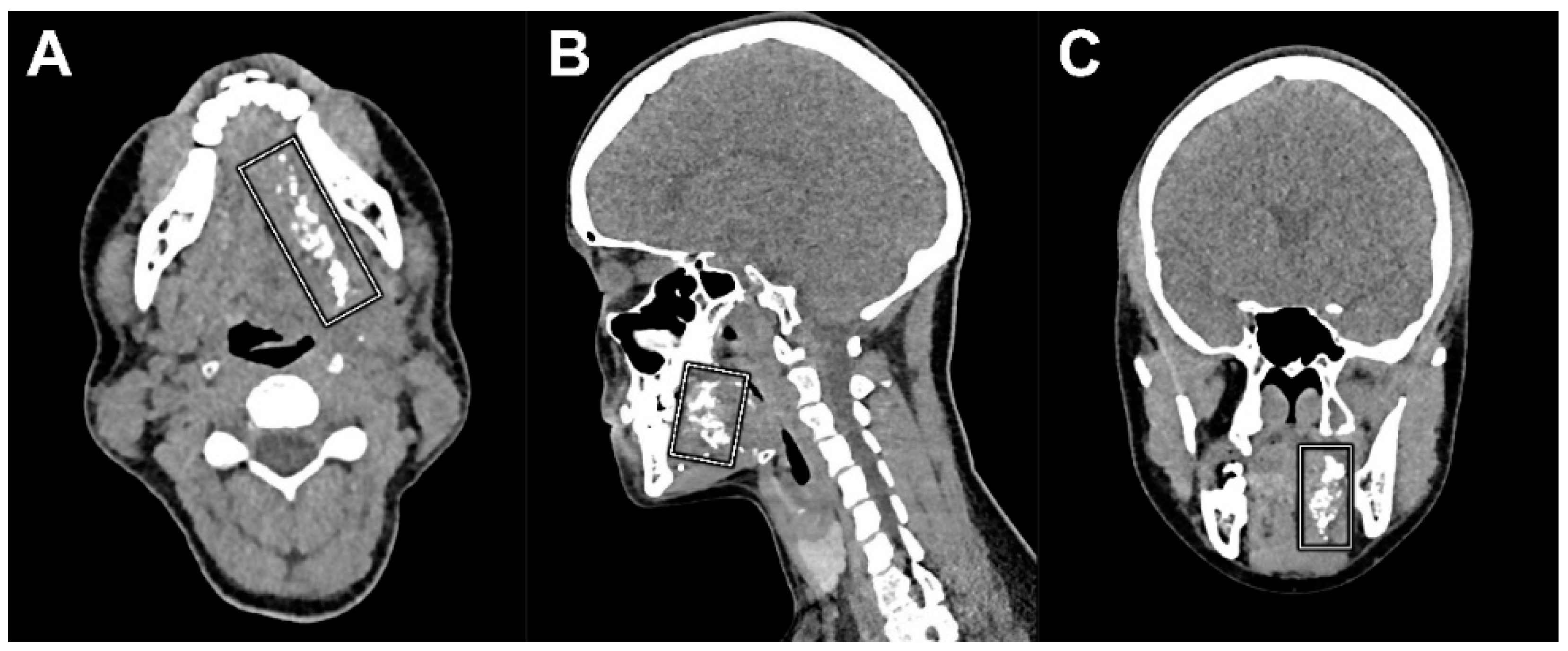 Jcm Free Full Text Ct Lymphography Using Lipiodol® For Sentinel