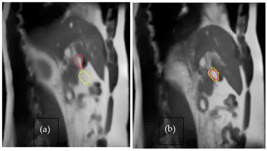 Emergence of MR-Linac in Radiation Oncology: Successes and Challenges ...