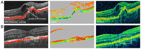 Advances in Optical Coherence Tomography Imaging Technology and Techniques for Choroidal and ...