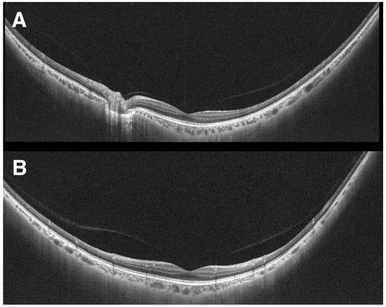 Advances in Optical Coherence Tomography Imaging Technology and ...