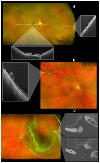 Advances in Optical Coherence Tomography Imaging Technology and Techniques for Choroidal and ...