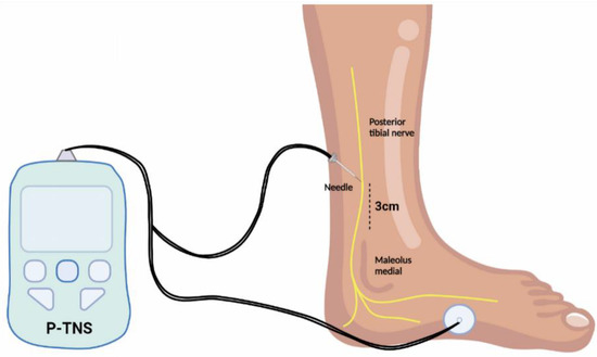 Physical Agent-Based Treatments for Overactive Bladder: A Review