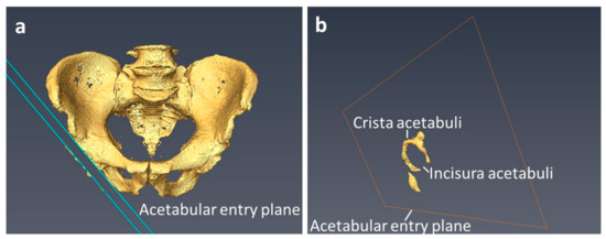 Lumbosacral Transitional Vertebrae Influence on Acetabular Orientation ...