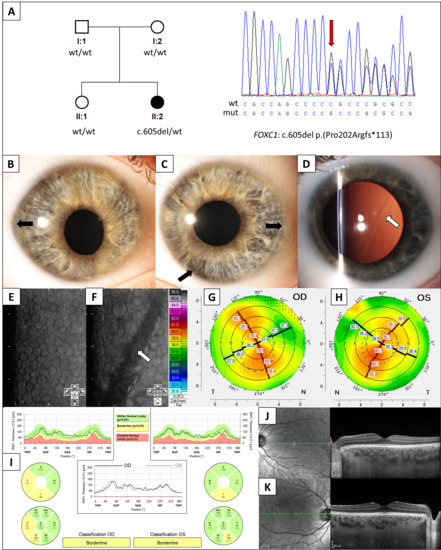 Snail Track Lesion with Flat Keratometry in Anterior Segment Dysgenesis ...