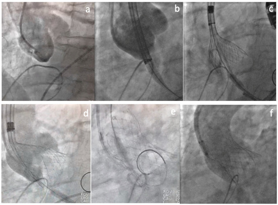 Transcatheter Aortic Valve Implantation for Pure Native Aortic ...