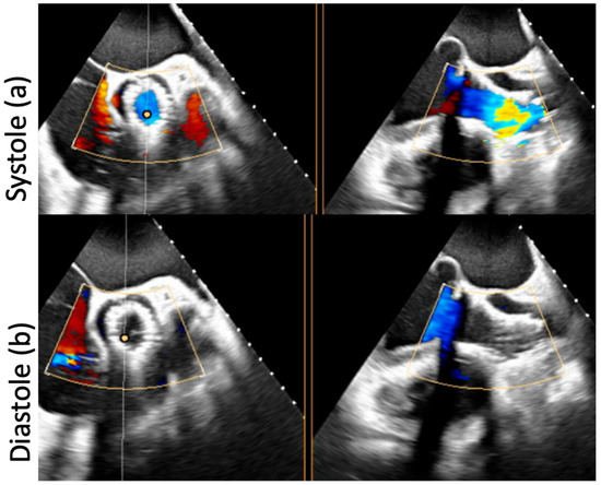 Transcatheter Aortic Valve Implantation for Pure Native Aortic ...