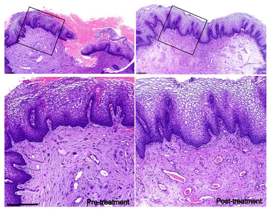 Fractional Carbon Dioxide Laser Improves Vaginal Laxity via Remodeling ...
