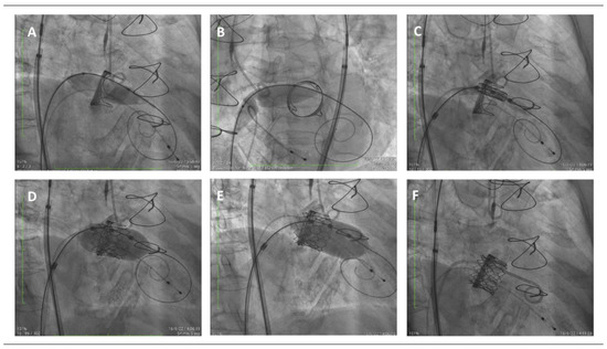 Transcatheter Mitral Valve-in-Valve Implantation with the Balloon ...