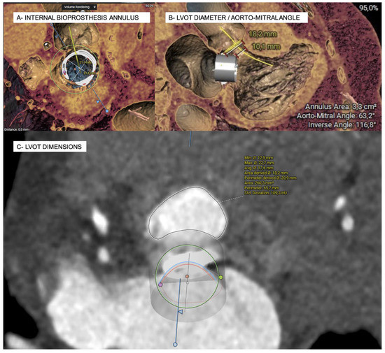 JCM | Free Full-Text | Transcatheter Mitral Valve-in-Valve Implantation ...