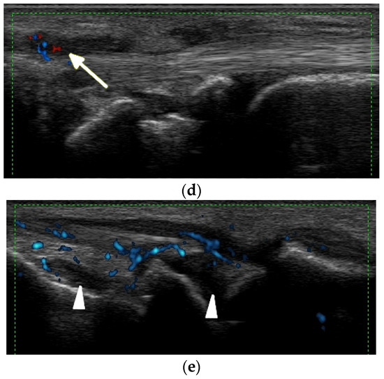 Update on Current Imaging of Systemic Lupus Erythematous in Adults and ...