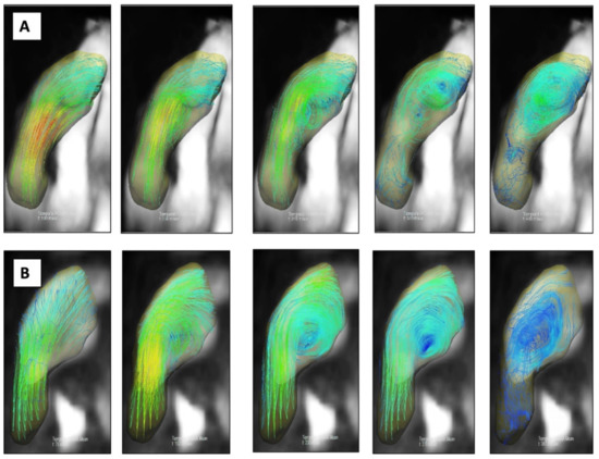 Correlation between Pulmonary Artery Pressure and Vortex Duration ...