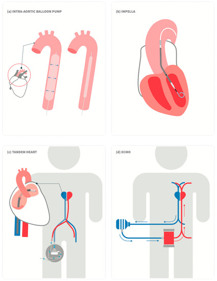 Mechanical Circulatory Support Devices for the Treatment of Cardiogenic ...