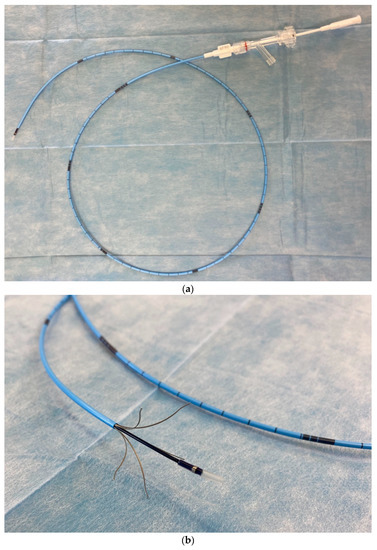 Klippel–Trenaunay Syndrome: Employment of a New Endovascular Treatment ...
