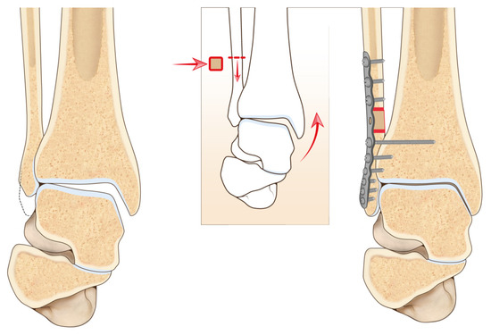 Reconstructive Surgery and Joint-Sparing Surgery in Valgus and Varus ...