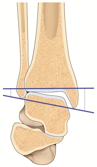 Reconstructive Surgery and Joint-Sparing Surgery in Valgus and Varus ...