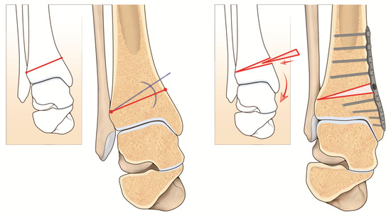 Reconstructive Surgery and Joint-Sparing Surgery in Valgus and Varus ...