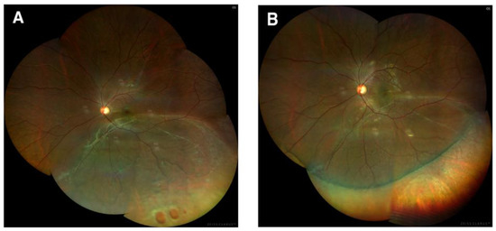 Surgical Success Rate of Scleral Buckling Surgery and Postoperative ...