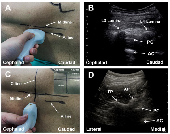 Dual- vs. Single-Plane Ultrasonic Scan-Assisted Positioning during ...