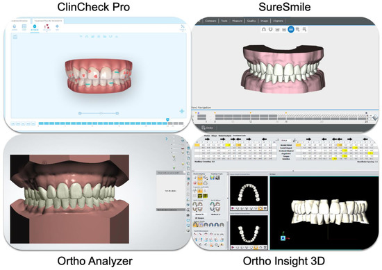 Comparing 3D Tooth Movement When Implementing the Same Virtual Setup on ...