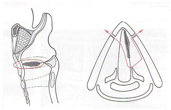 Open Partial Laryngectomies: History of Laryngeal Cancer Surgery