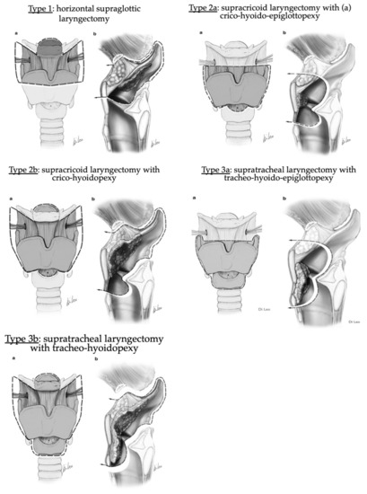 Open Partial Laryngectomies: History of Laryngeal Cancer Surgery