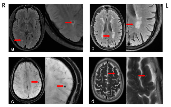 Total Burden of Cerebral Small Vessel Disease on MRI May Predict ...