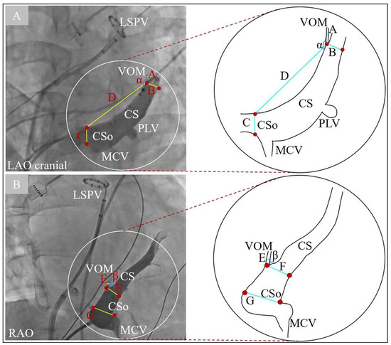Angiographic Characteristics of the Vein of Marshall in Patients with ...