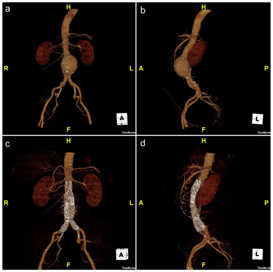 Endovascular Abdominal Aortic Aneurysm Repair: Overview of Current Guidance, Strategies, and New ...