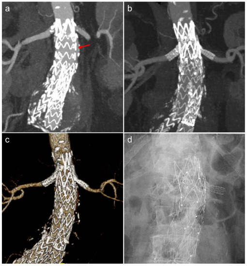 Endovascular Abdominal Aortic Aneurysm Repair: Overview of Current Guidance, Strategies, and New ...