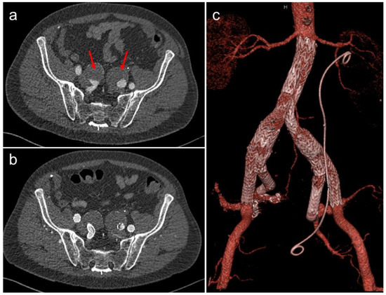 Endovascular Abdominal Aortic Aneurysm Repair: Overview of Current ...