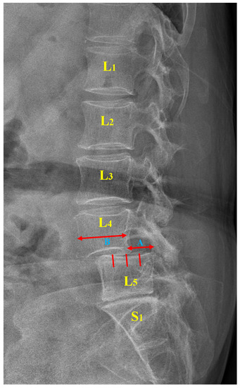 Detection of Lumbar Spondylolisthesis from X-ray Images Using Deep Learning Network