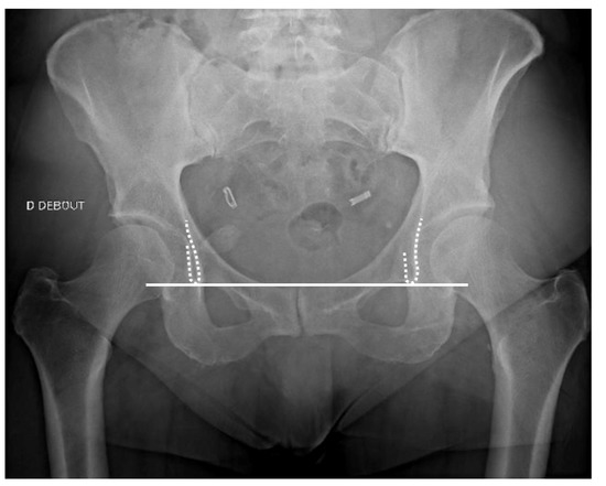 Imaging in Hip Arthroplasty Management—Part 1: Templating: Past ...
