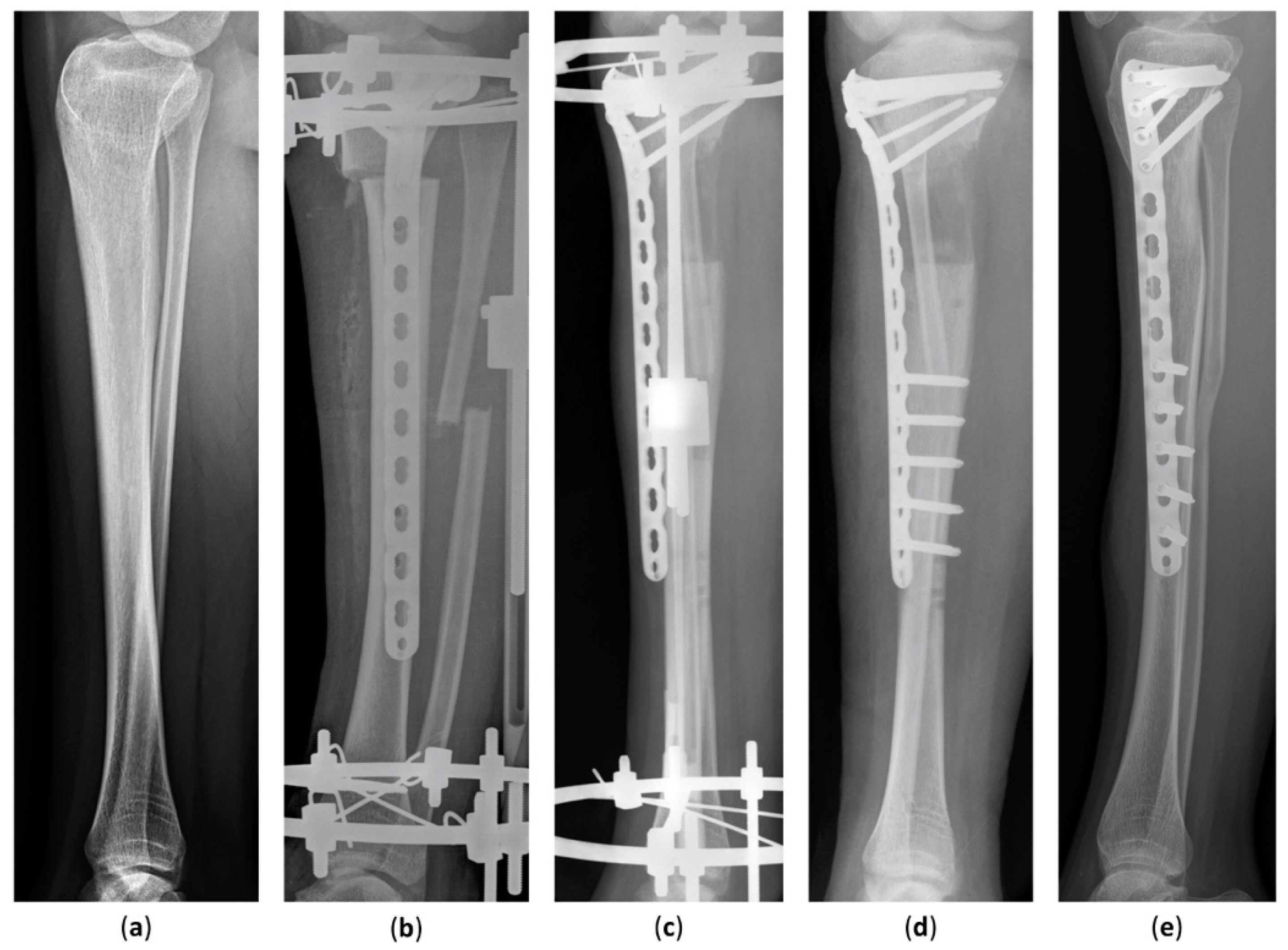 Tibial Lengthening along Submuscular Plate with Simultaneous Acute ...