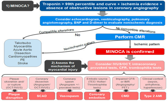 MINOCA: One Size Fits All? Probably Not—A Review of Etiology ...