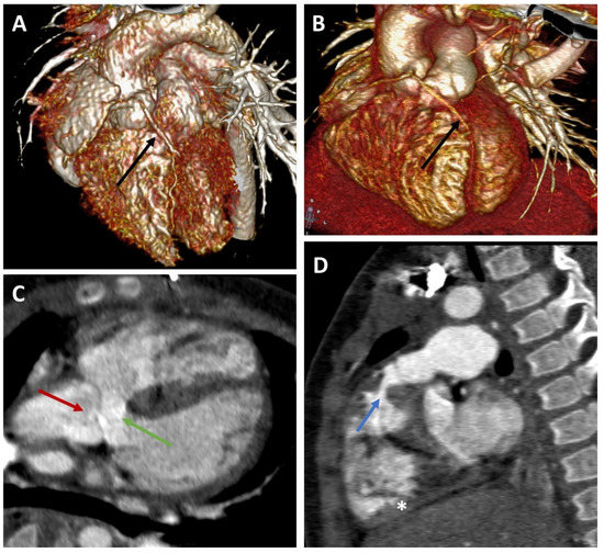 Detection of Coronary Artery and Aortic Arch Anomalies in Patients with Tetralogy of Fallot ...